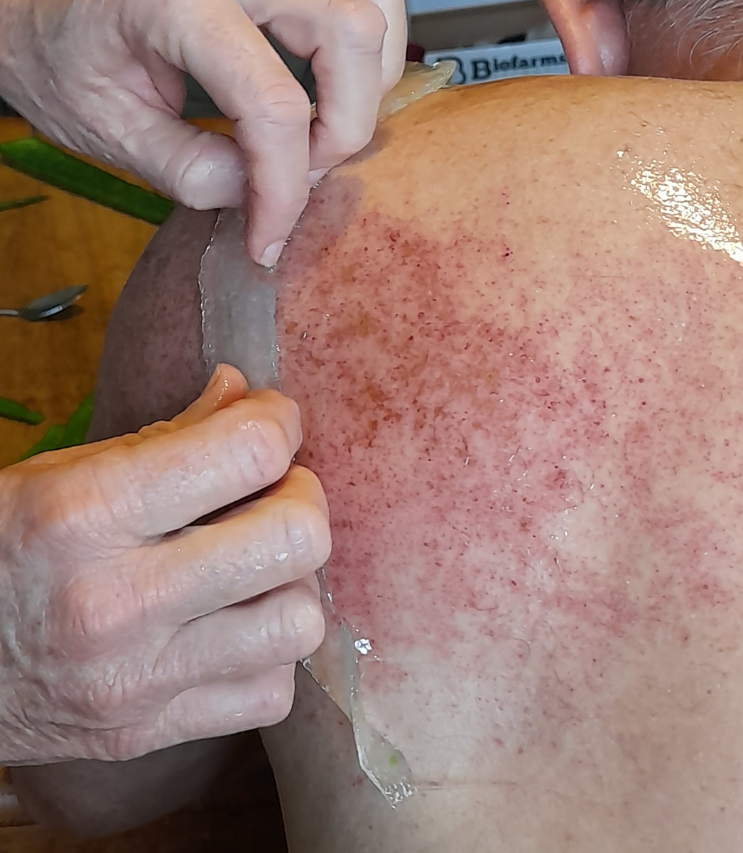 Fresh Aloe Vera For Burns + before & after pics | A Real Green Life