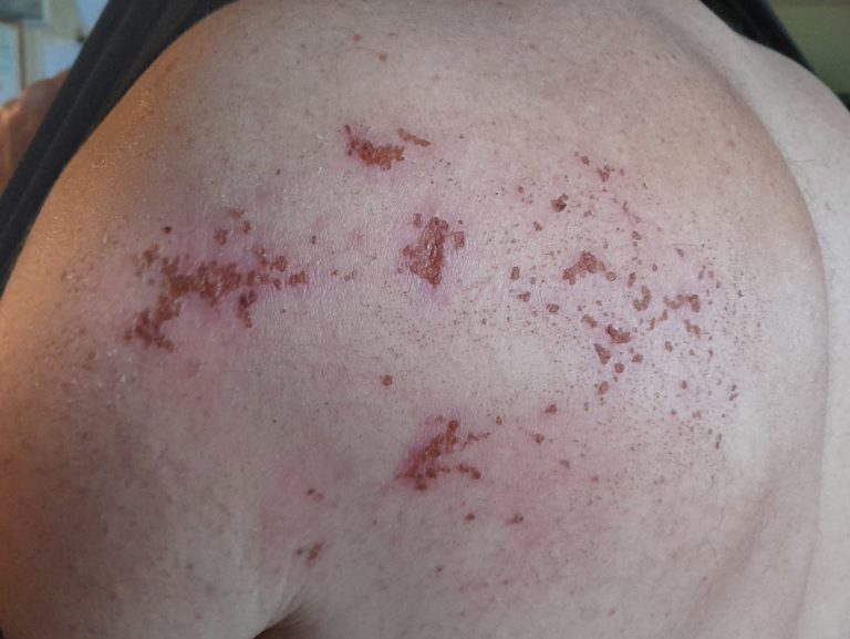 Fresh Aloe Vera For Burns + before & after pics | A Real Green Life